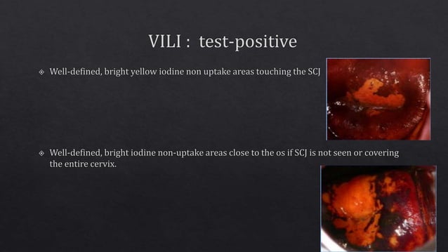 Vili ( Visual inspection lugol's iodine) | PPT
