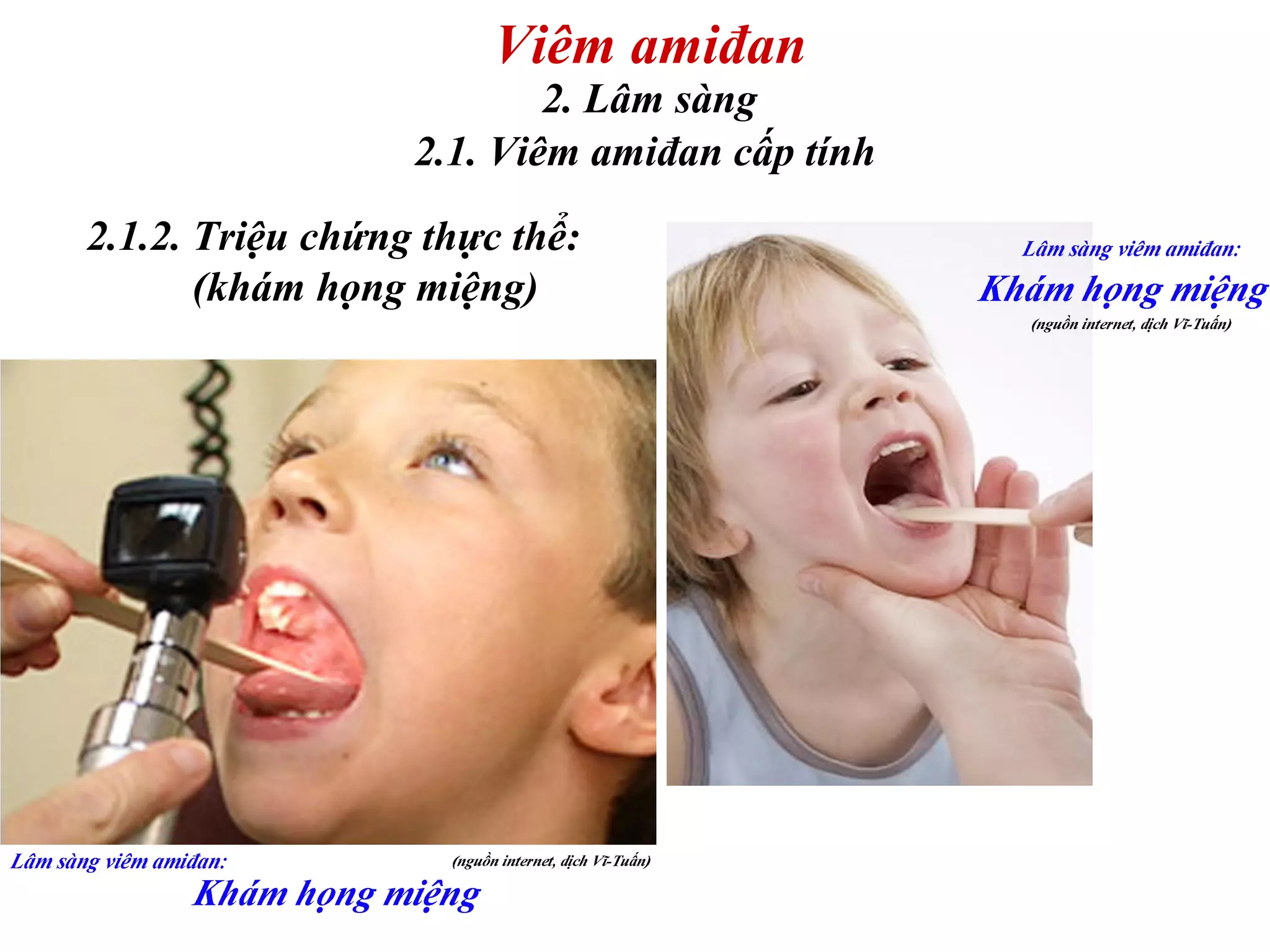 Viêm amidan Bài giảng đại họ Y khoa Phạm Ngọc Thạch | PPT