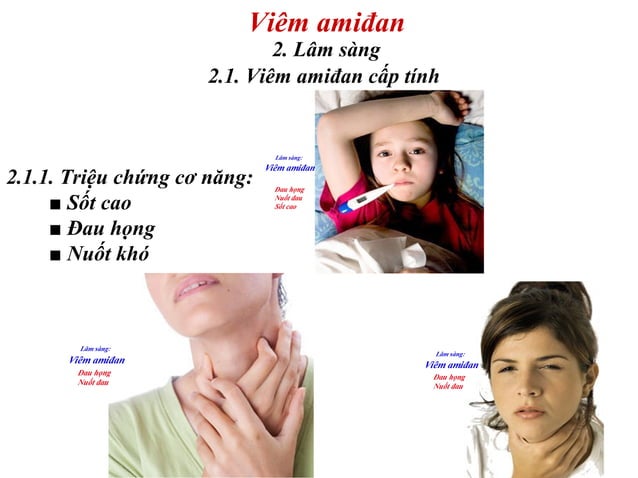 Viêm amidan Bài giảng đại họ Y khoa Phạm Ngọc Thạch | PPT