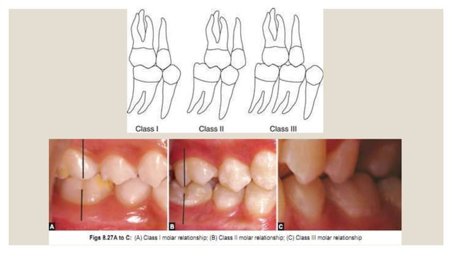 Tutorial Maloklusi & Crossbite
