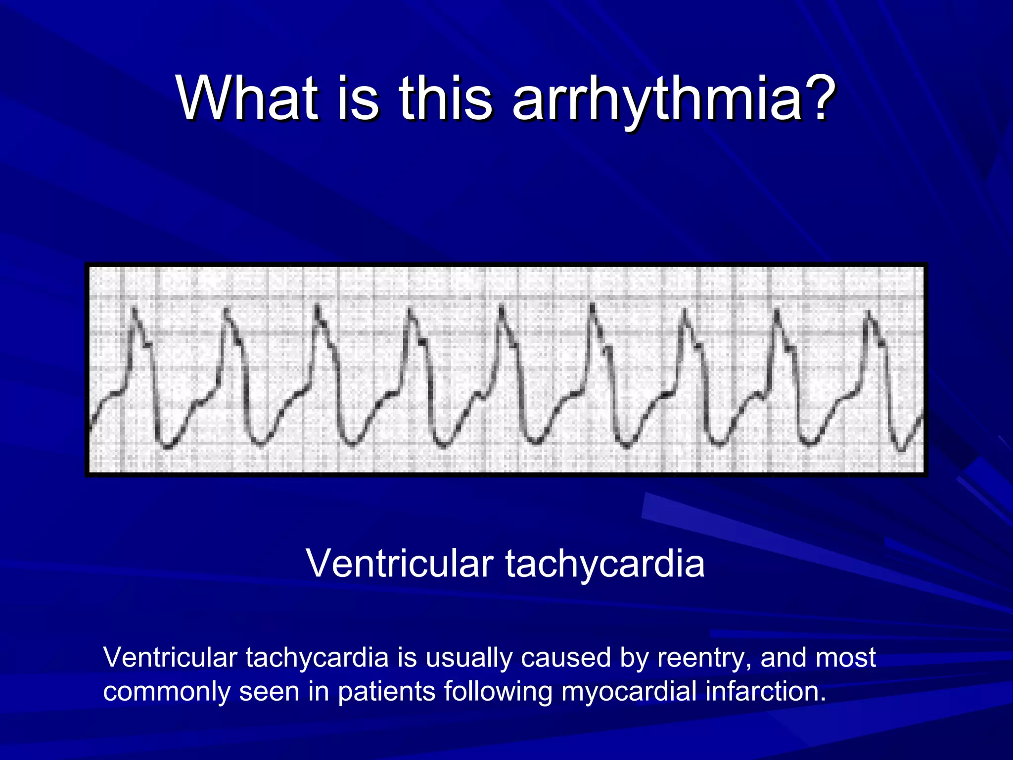 Venticular conduction disorders by dr vinay verma | PPT
