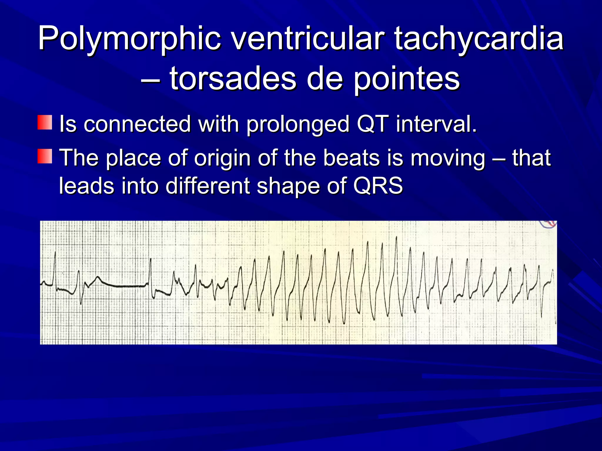Venticular conduction disorders by dr vinay verma | PPT