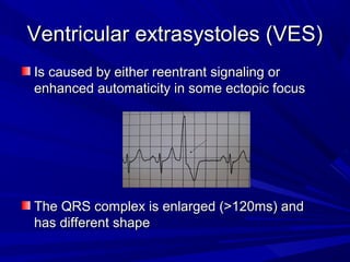 Venticular conduction disorders by dr vinay verma | PPT