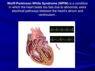 Venticular conduction disorders by dr vinay verma | PPT