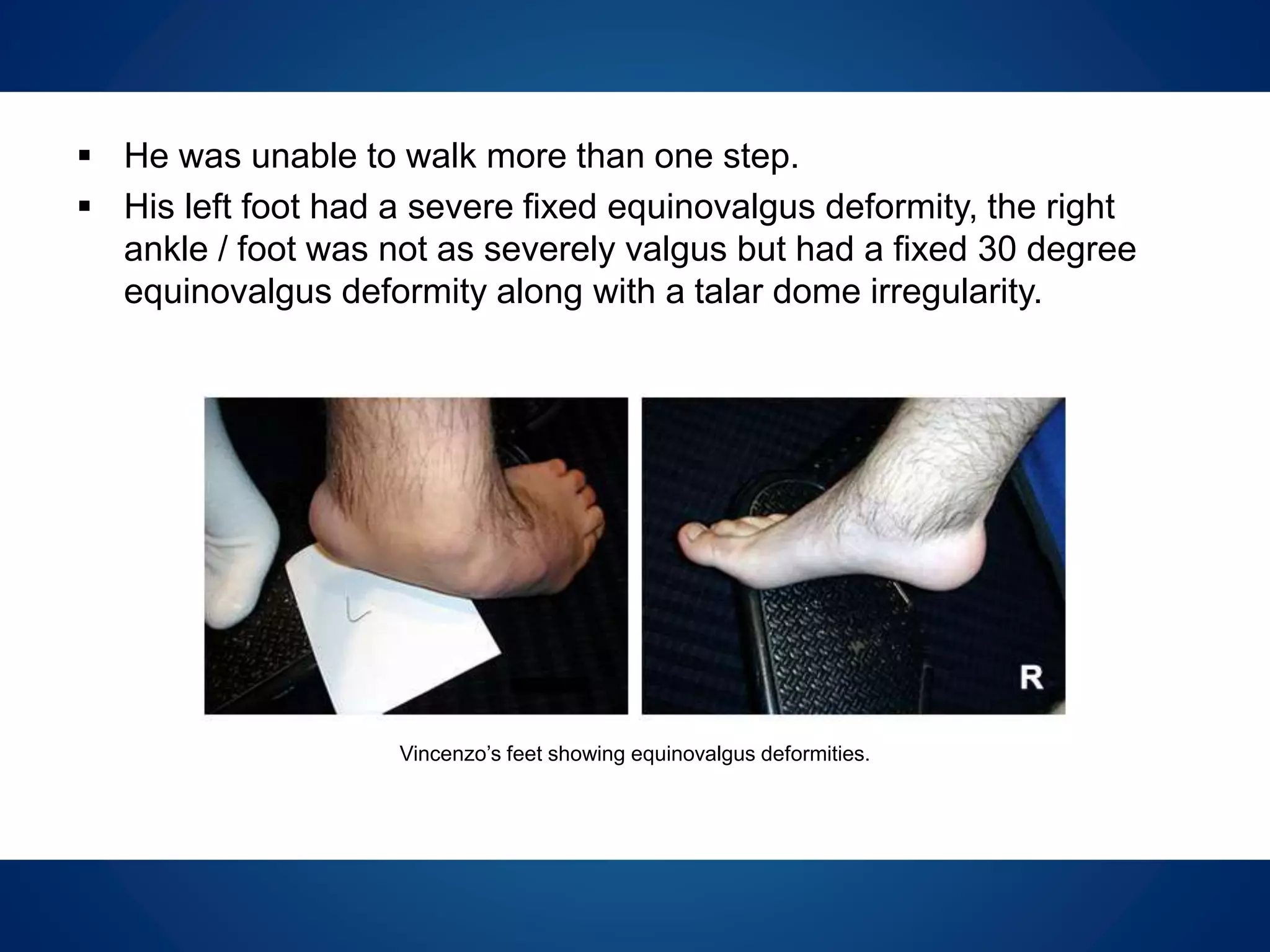 Vincenzo: Arthrogryposis w/ Lower Limb Deformities, Severe Contractures ...