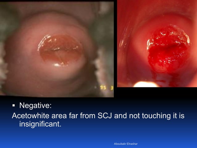 Visual inspection of cervix | PDF