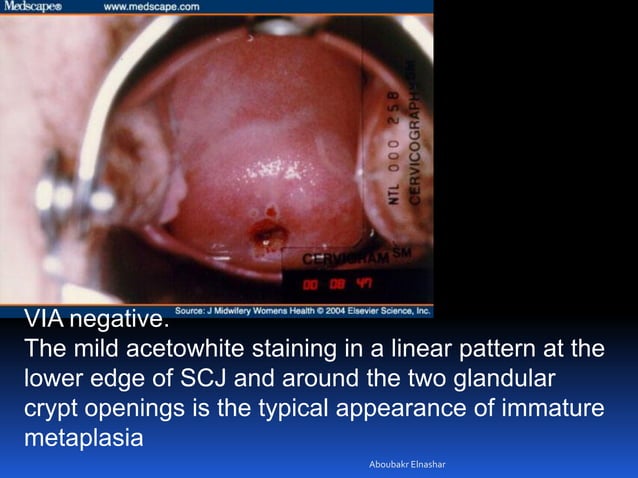 Visual inspection of cervix | PDF