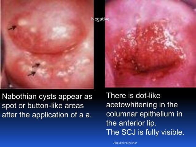 Visual inspection of cervix | PDF