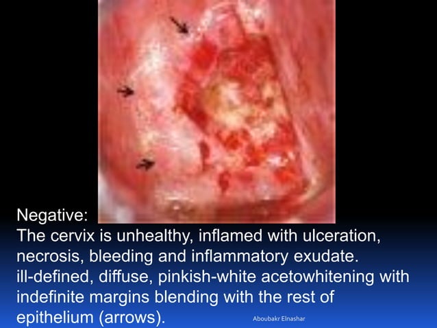 Visual inspection of cervix | PDF