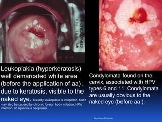 Visual inspection of cervix | PDF