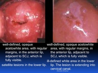 Visual inspection of cervix | PDF