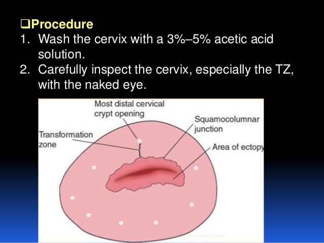 Visual inspection of cervix