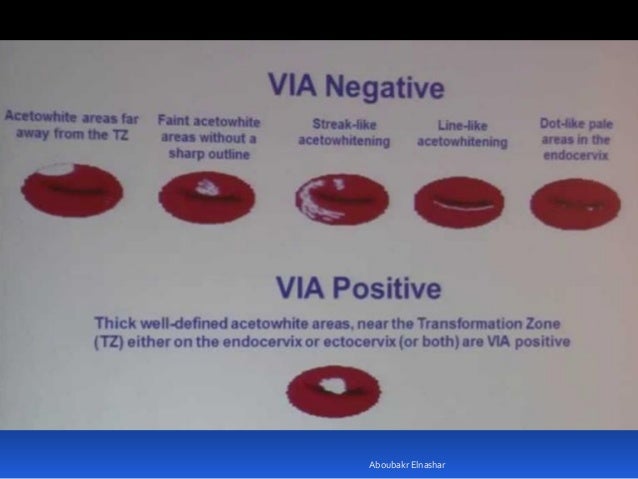 Visual inspection of cervix