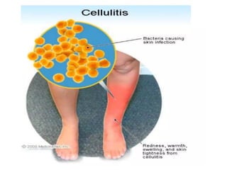 Clinical approach and principle of management of cellulitis and necrotising fascitis | PPTX ...
