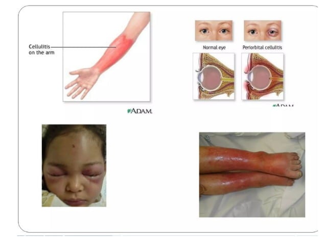 Clinical approach and principle of management of cellulitis and necrotising fascitis | PPTX ...