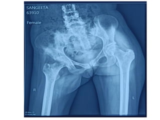 CASE PRESENTATION ON PATHOLOGY AROUND HIP JOINT.pptx