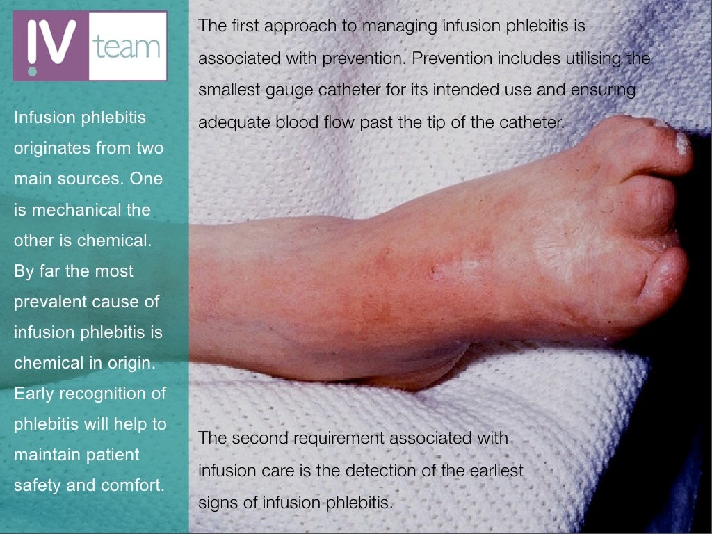 Introduction to the Visual Infusion Phlebitis (VIP) score