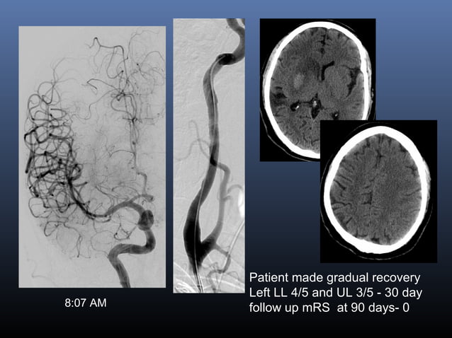 Intervention in Stroke-A New Era | PPT