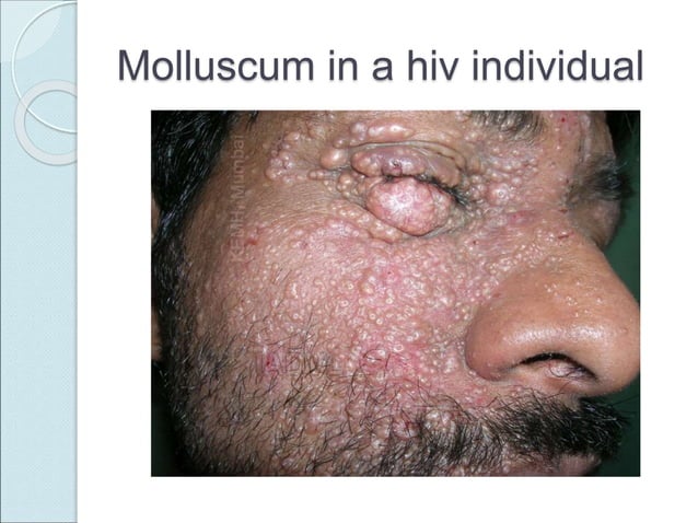 viral.ppt | Skin and Dermatology | Diseases and Conditions