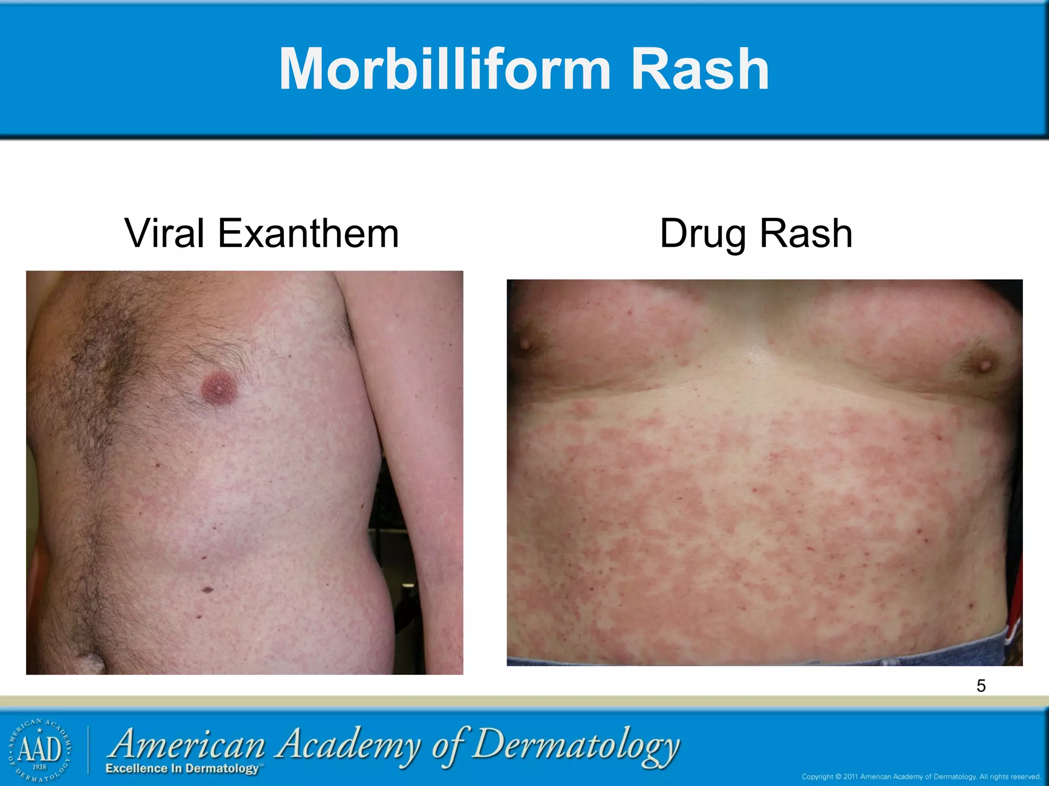 Viral exanthems | PPT