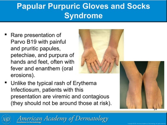 Viral exanthems | PPT | Skin and Dermatology | Diseases and Conditions