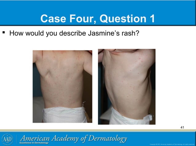 Viral exanthems | PPT | Skin and Dermatology | Diseases and Conditions