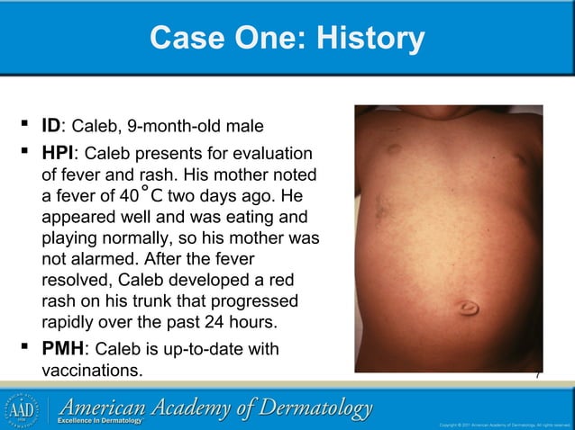 Viral exanthems | PPT | Skin and Dermatology | Diseases and Conditions