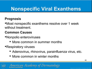 Viral exanthems | PPT