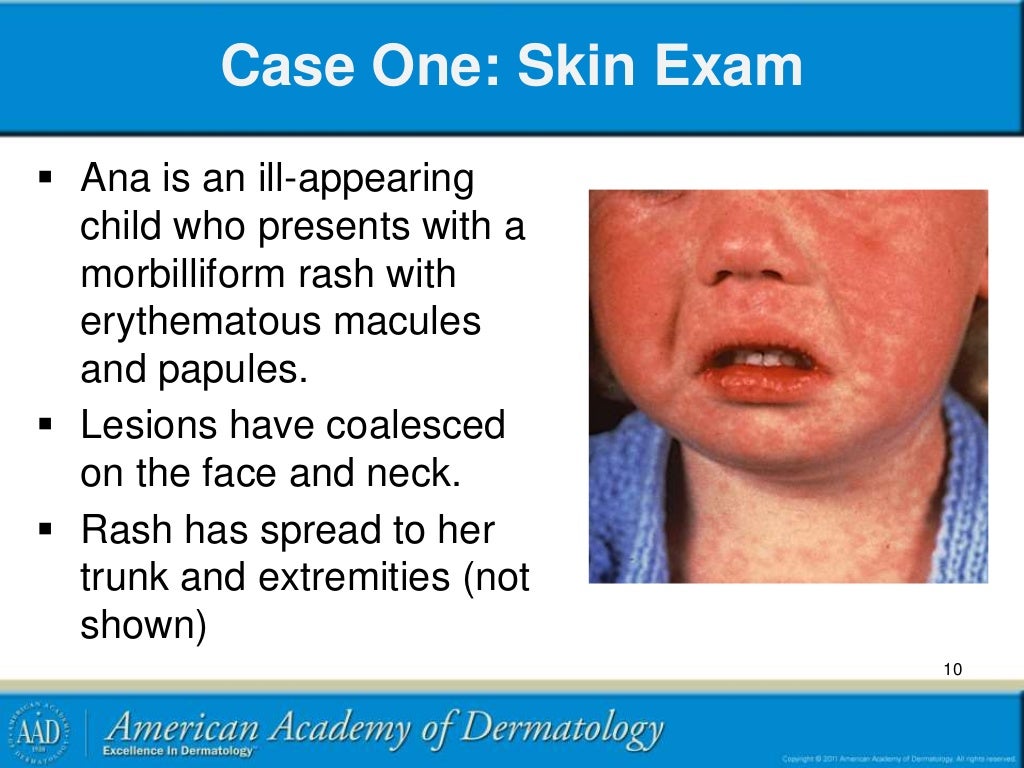 Viral exanthems-module