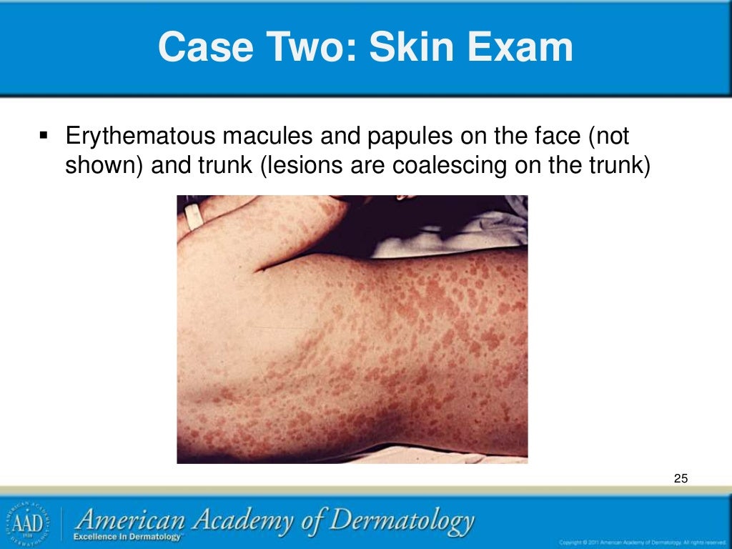 Viral exanthems-module