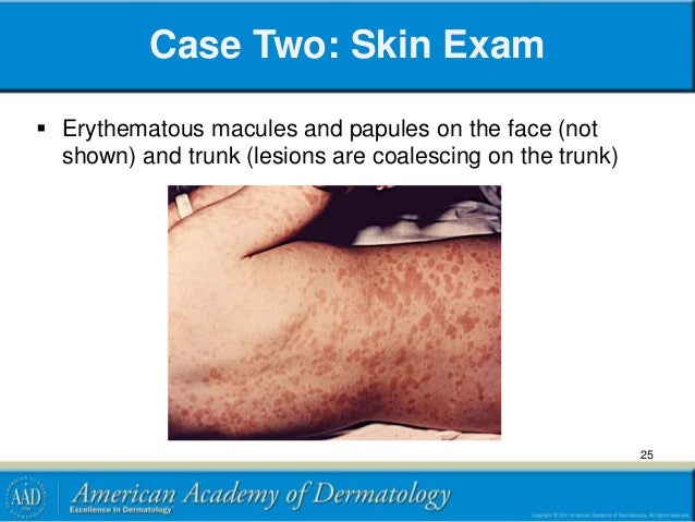 Viral exanthems-module