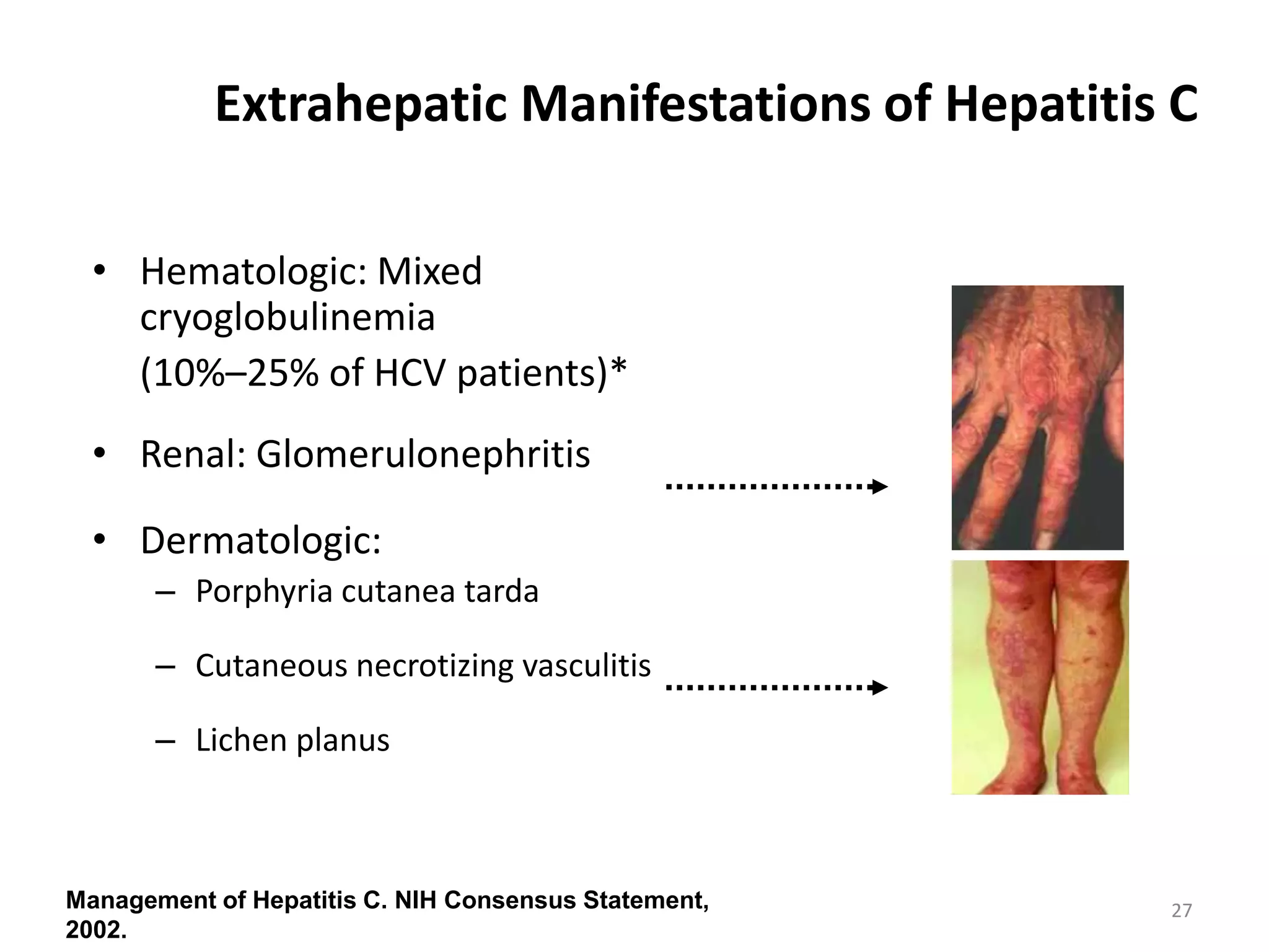 Viral hepatitis- At a glance.ppt