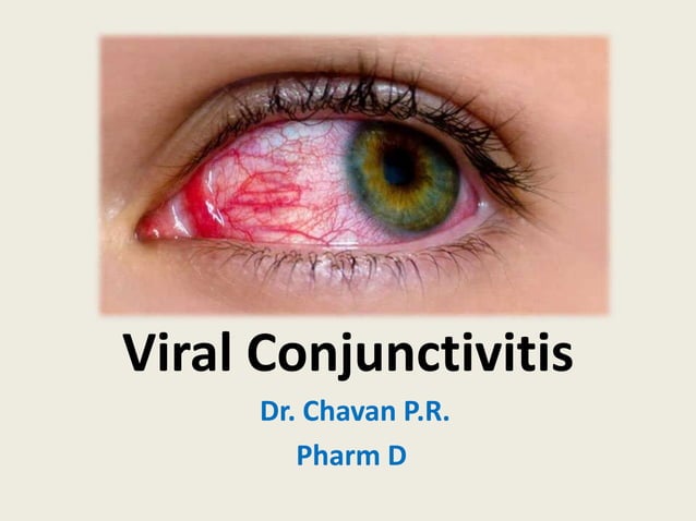 Viral conjunctivitis basic overview | PPTX