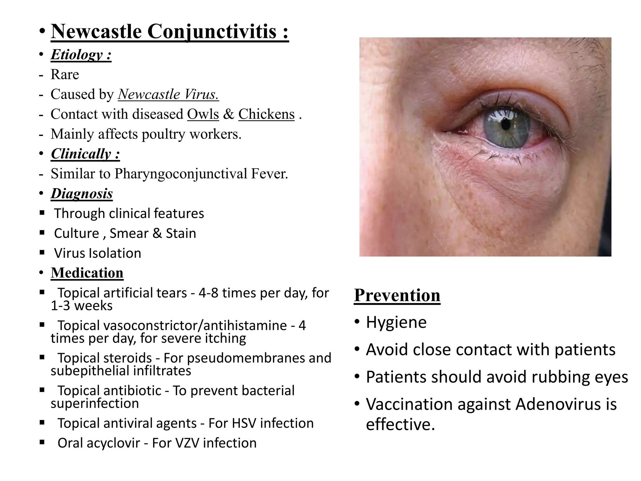 Viral conjunctivitis | PPTX