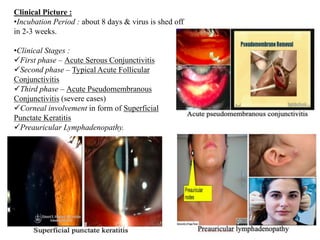 Viral conjunctivitis | PPTX