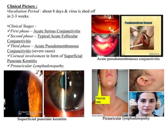 Viral conjunctivitis | PPTX