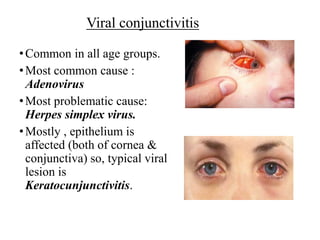 Viral conjunctivitis | PPTX