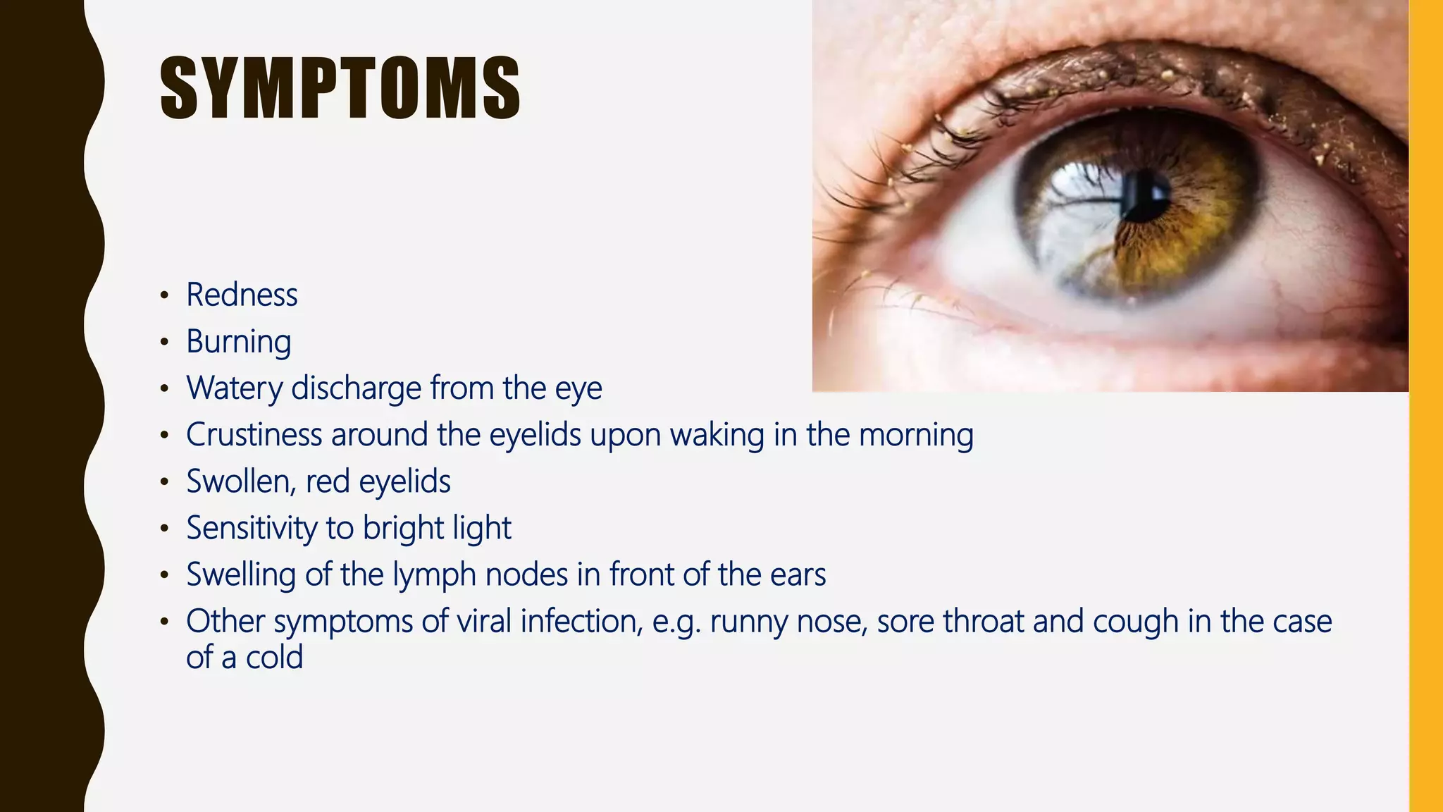 Viral conjunctivitis | PPTX