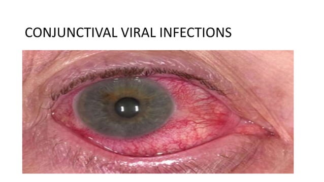 Viral conjunctivitis