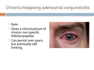 Viral Conjunctivitis and it;s managment.pptx
