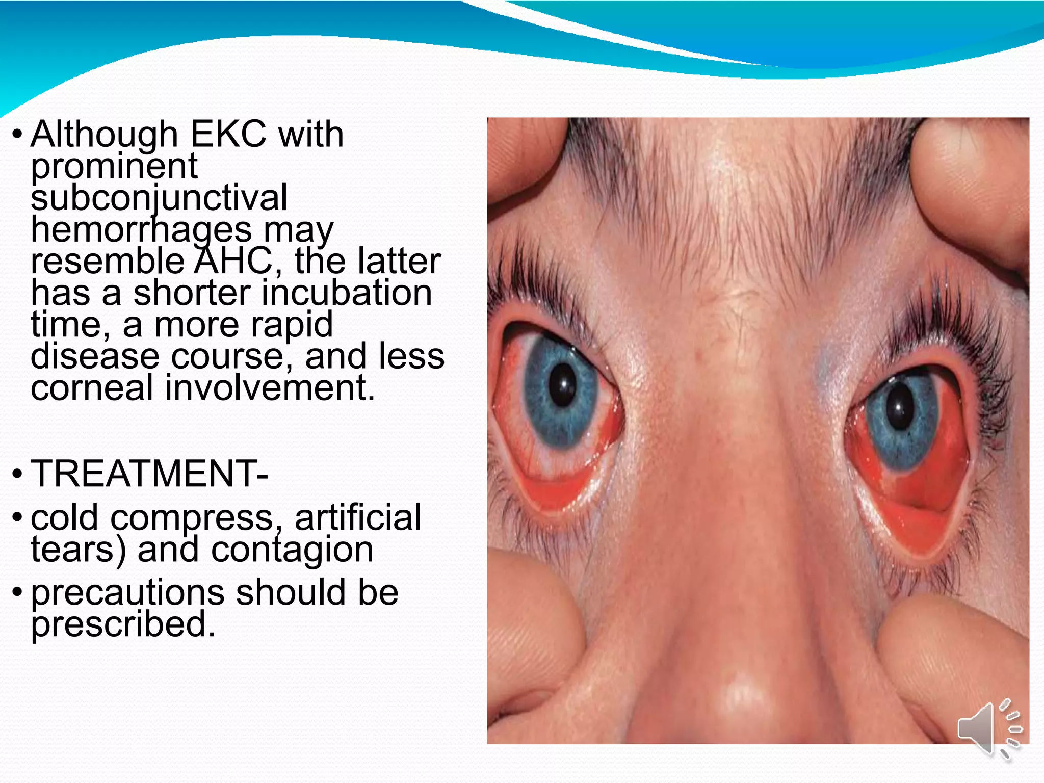 Viral conjunctivitis - DR ARNAV | PPTX