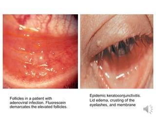 Viral Conjunctivitis Follicles