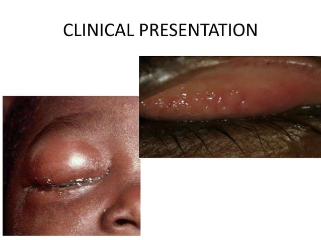 VIRAL CONJUNCTIVITIS Lecture-EKC (1).pptx