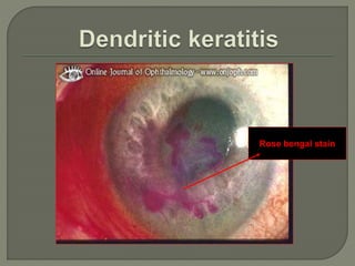 Hsv Dendritic Keratitis Rose Bengal