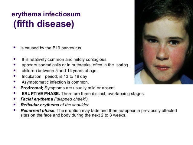 Erythema Subitum