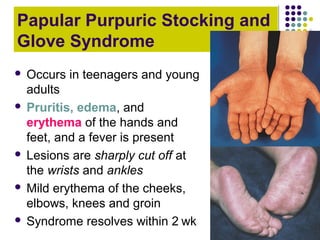 Papular Purpuric Gloves And Socks Syndrome