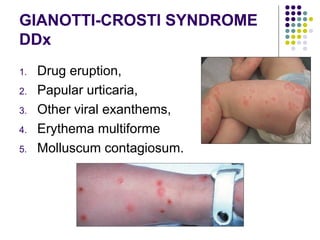 Gianotti Crosti Molluscum