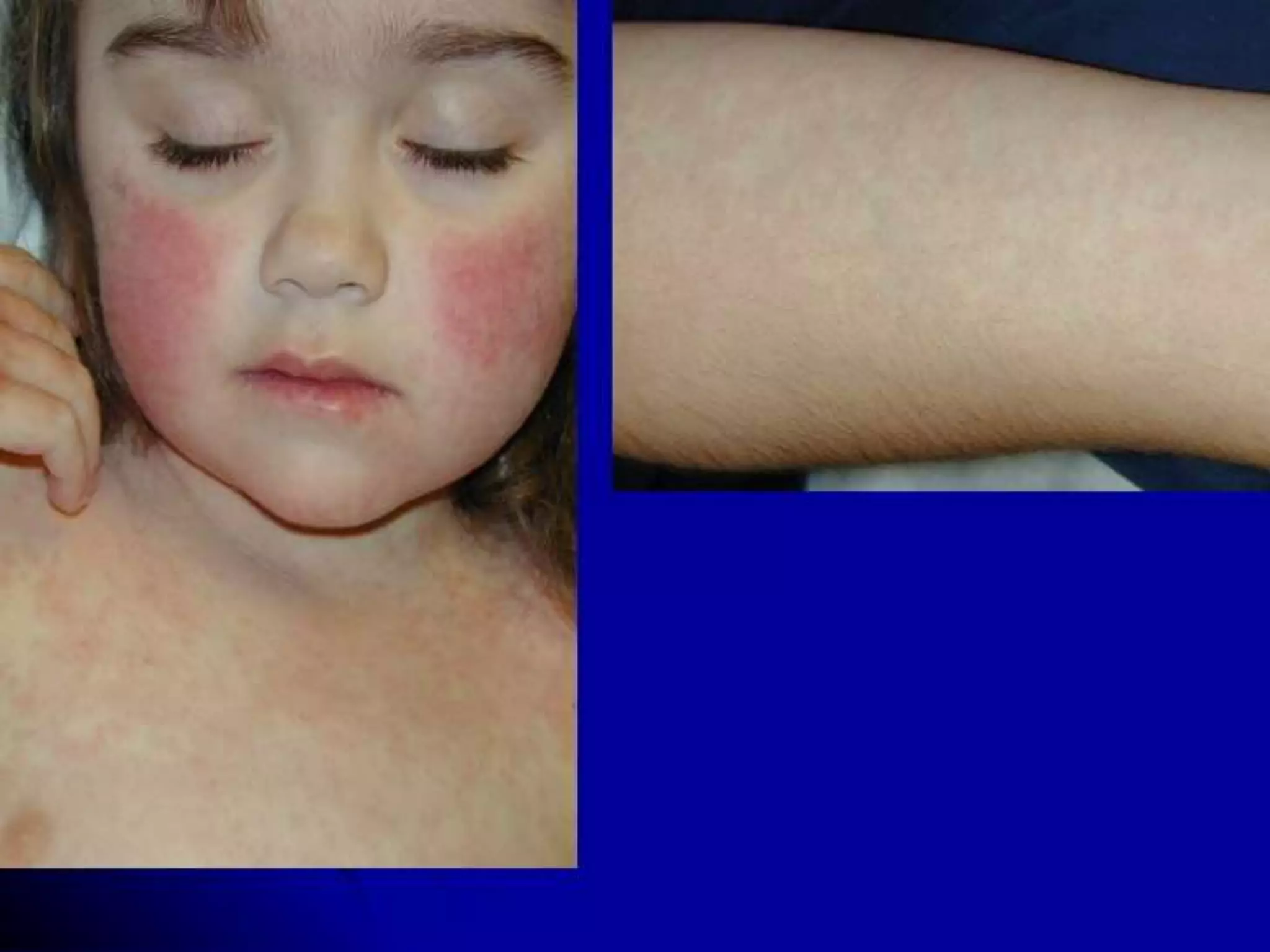 Viral exanthem | PPTX