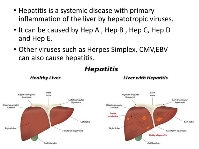Viral hep | PPT