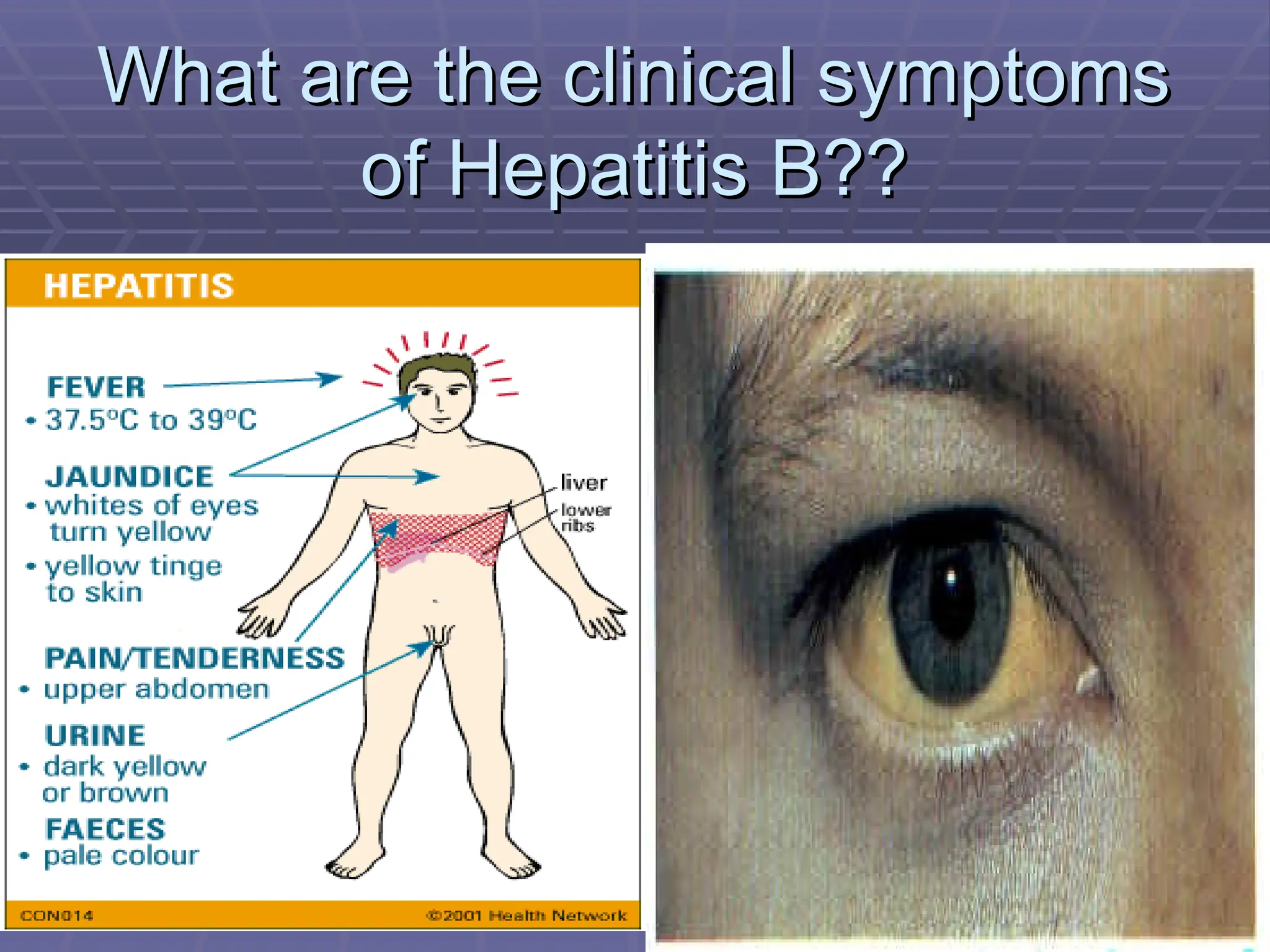 viral hepatitis good.ppt............................. | PPT